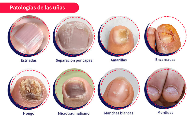 Anatomía de las uñas: Estructura y patologías comunes